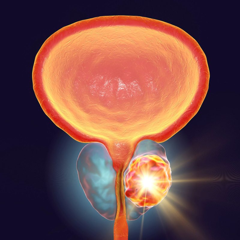 7 Signs of Prostate Cancer and How It's Diagnosed
